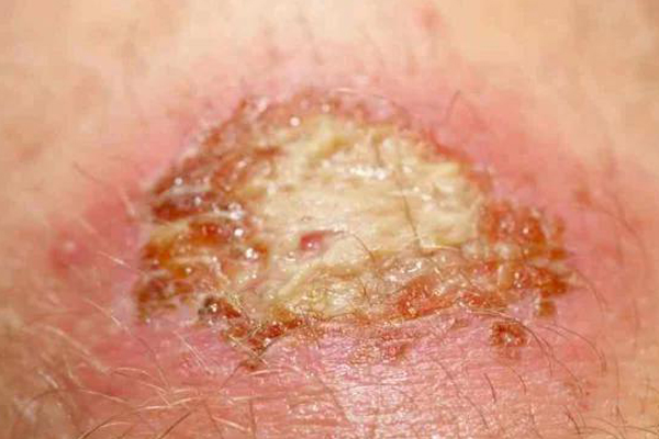 Herida infectada: signos, tratamiento y prevención | CuraCare